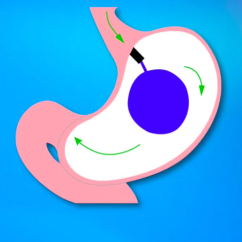 Intragastric Balloon Austin, TX | Dr. Steven Fass